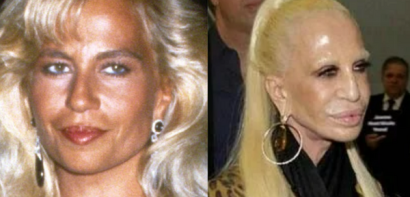 Donatella Versace Before and After Plastic Surgery Journey