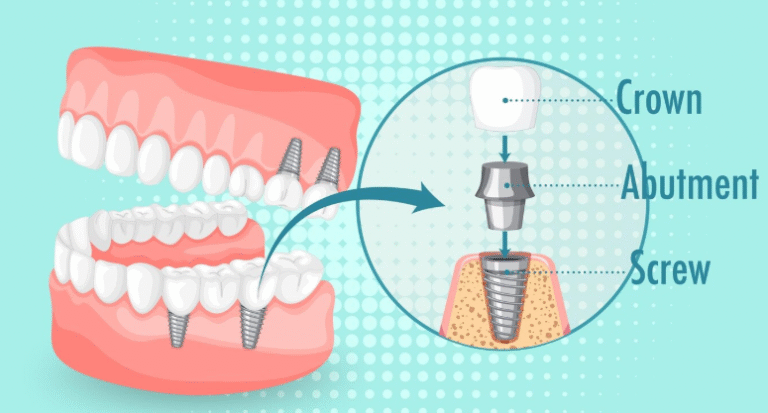 Multiple Tooth Implant: Cost, Process and Results - Estevien